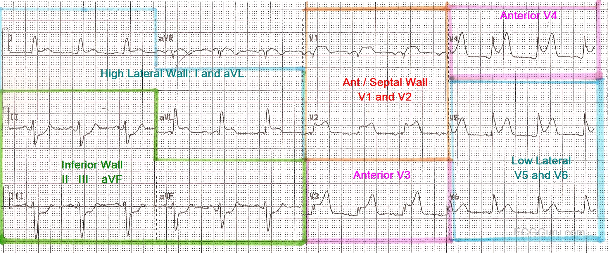 Mapped 12 Lead ECG ECG Guru Instructor Resources